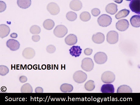 Lab Atlas: Hemoglobin H