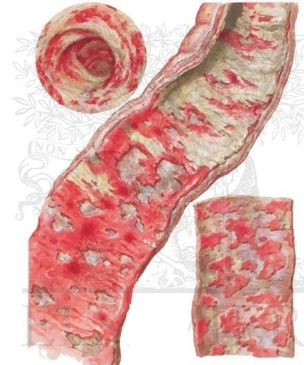 DISEASE Amoebic Dysentery - All Body Disease