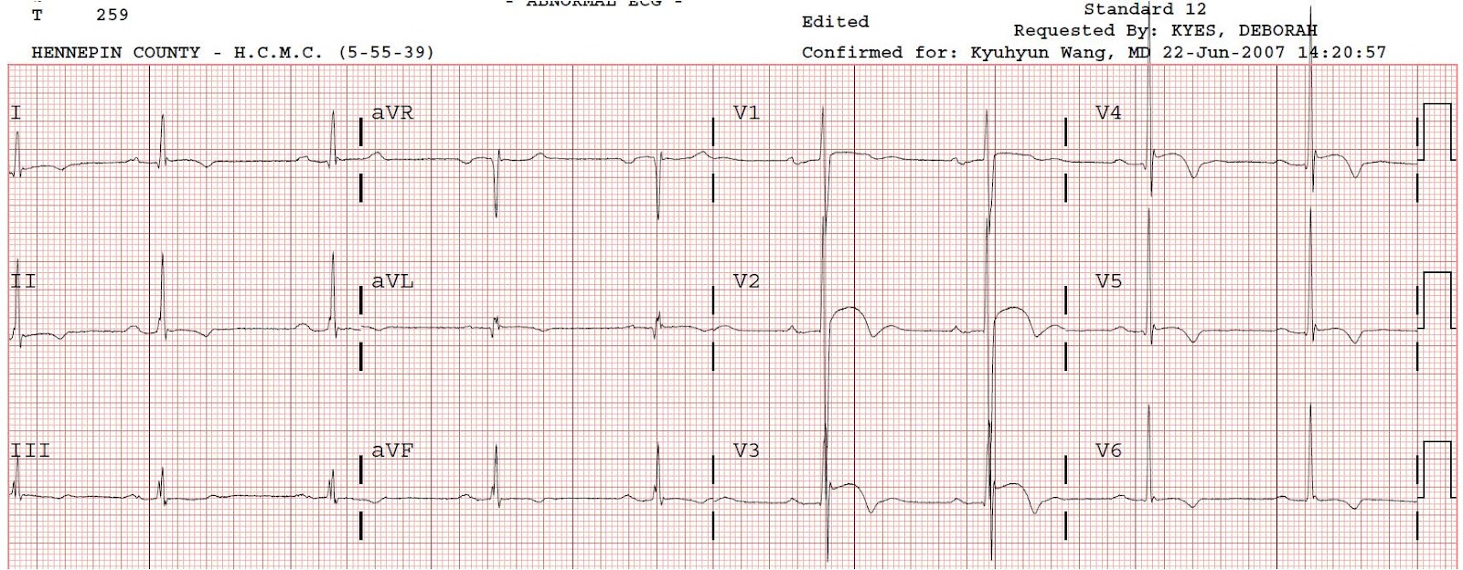 Dr. Smith's ECG Blog: Benign T-wave Inversion: view video or read text