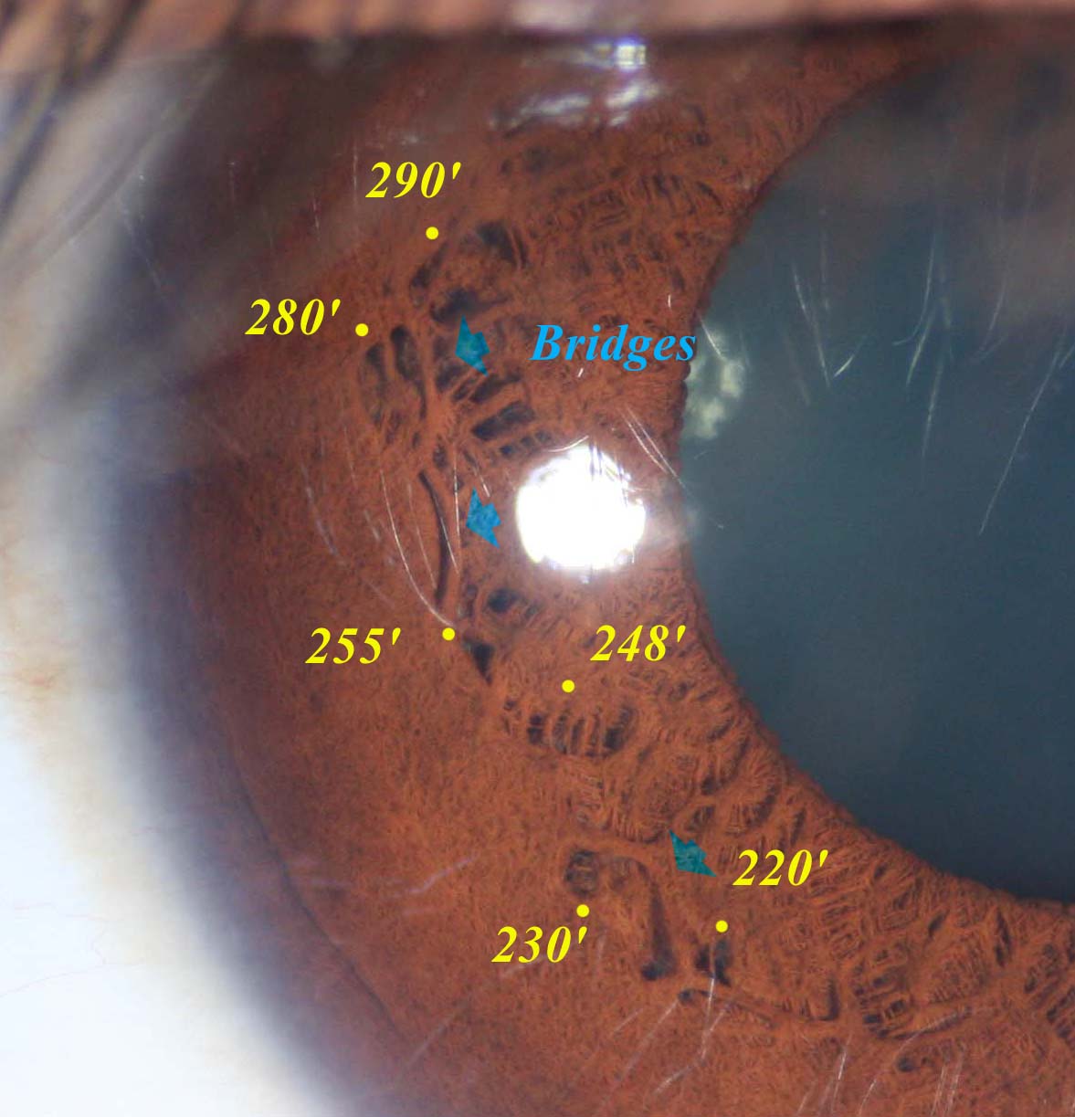 Modern & Multidimensional Iridology: Crypts at Pupillary Zone ...