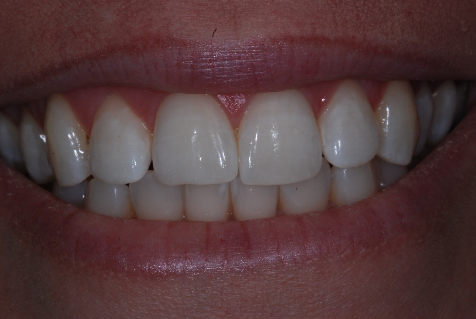 how tooth decay in soda