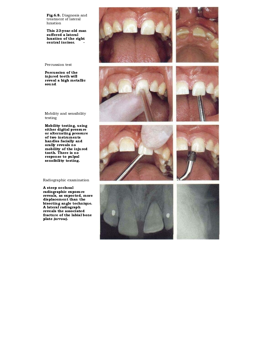 DOs and DONTs in DENTISTRY: CONCUSSION ,SUBLUXATION,EXTRUSION ,LATERAL ...