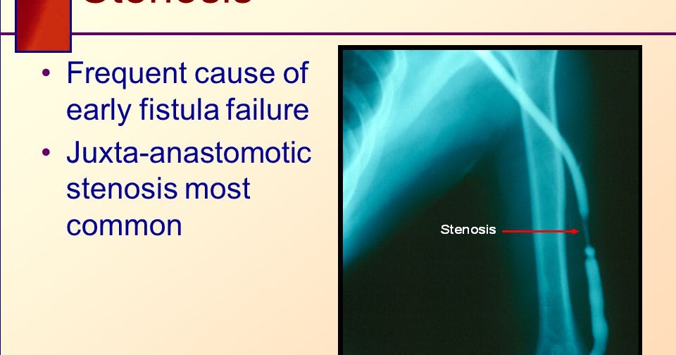 MEDICINE: Management of autogenous arteriovenous (AV) fistula stenosis ...