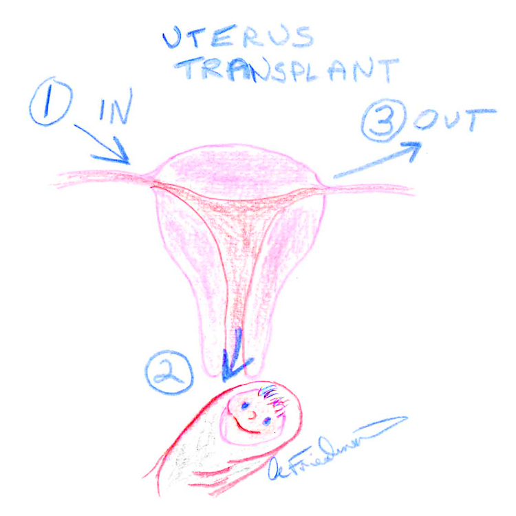 What's Hot / What's New: WHY TRANSPLANT A UTERUS?