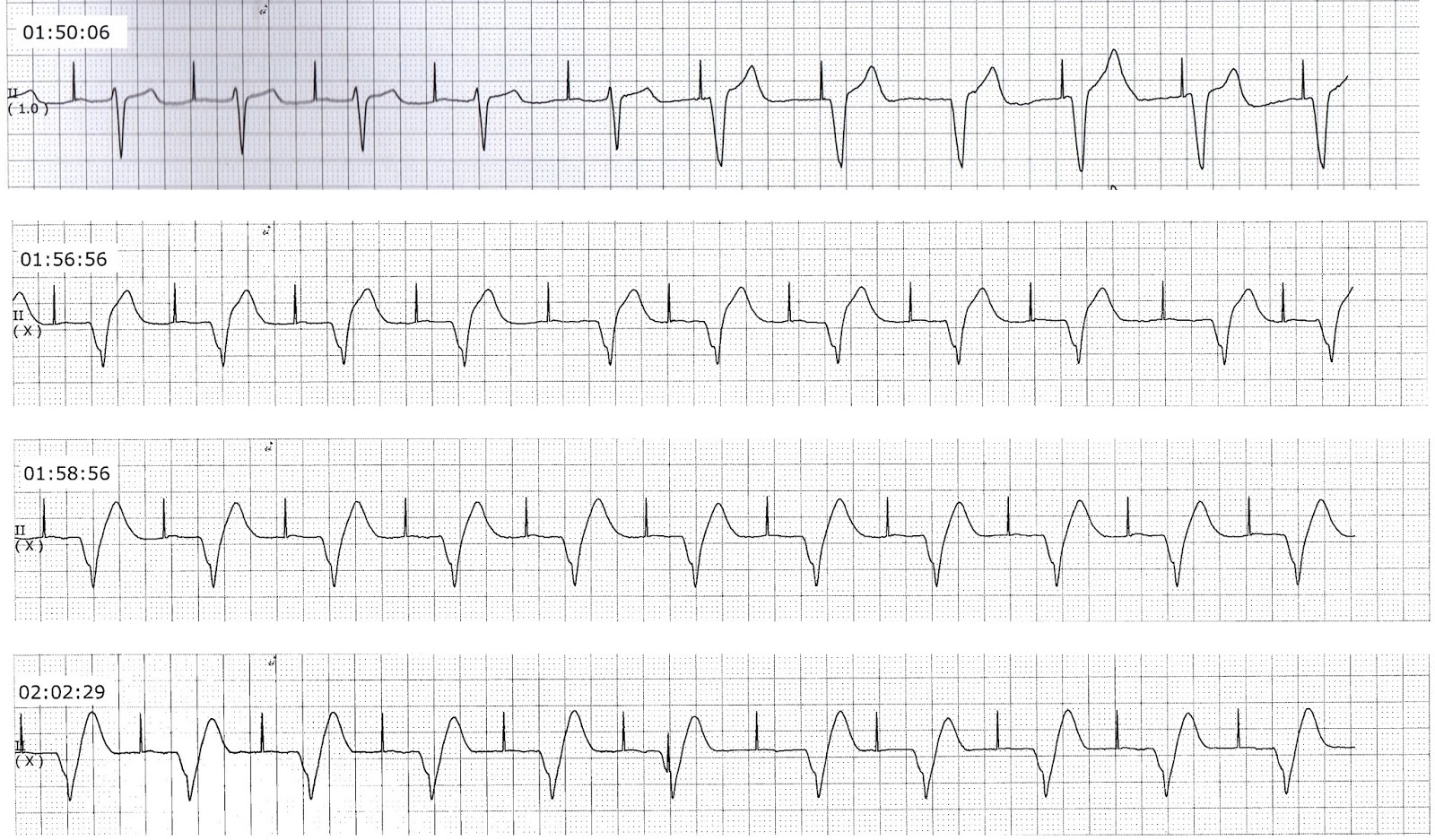 ECG Rhythms: Can you recognize death by just looking at telemetry (ECG ...