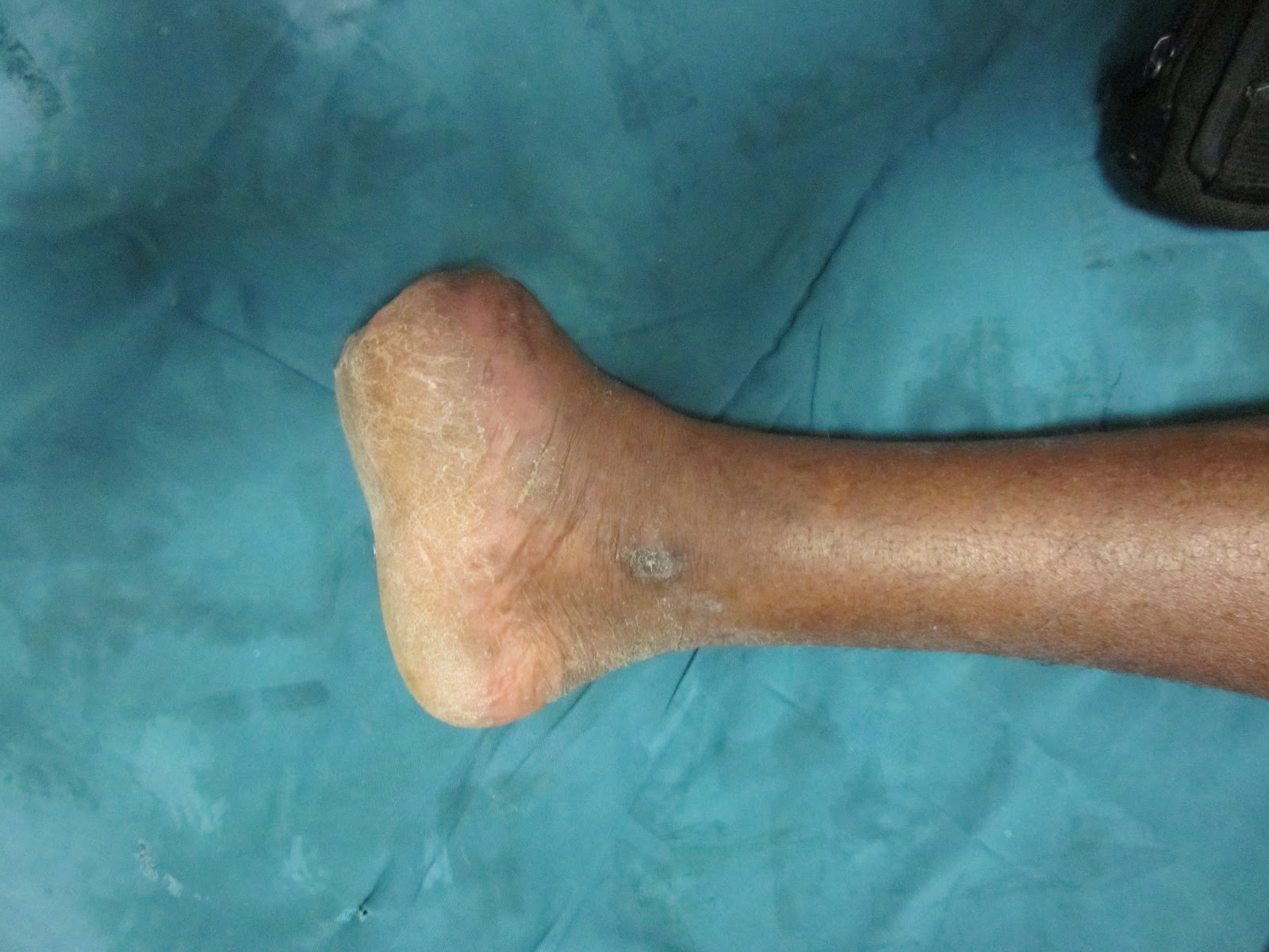 TRAUMATIC AMPUTATION OF MIDFOOT | CRUSH INJURY FOOT, LOWER LIMB ...