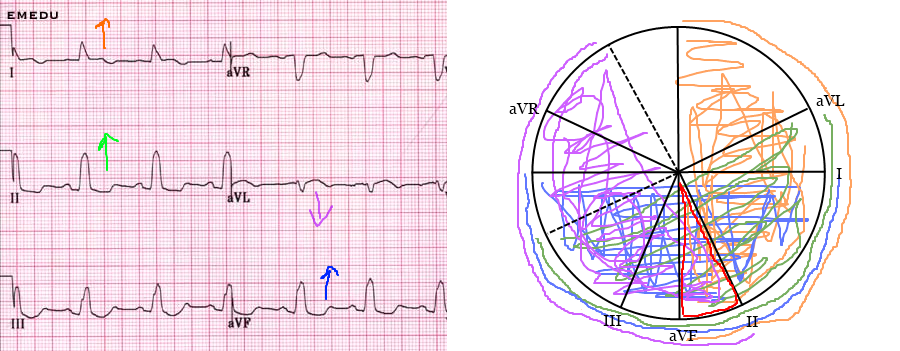 How important is axis deviation in EMS? | EMTLIFE