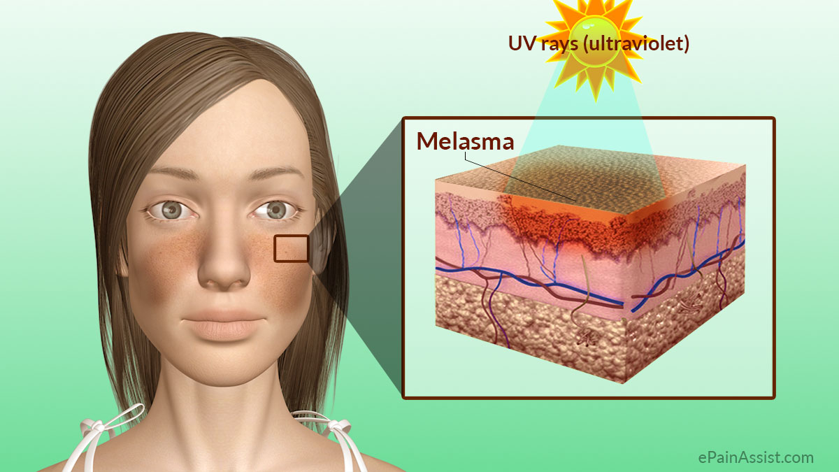 Askep pada Pasien dengan Melasma Lengkap - askep