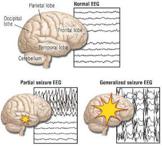 Pengertian, Prosedur, dan Komplikasi EEG (Electroencephalogram) | Medkes
