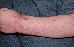 Dermatitis eccematosa aguda