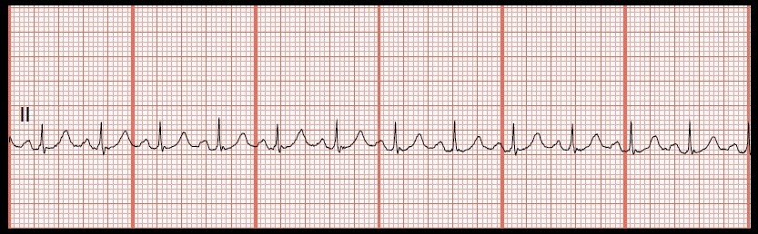 Practice EKG Rhythm Strips 228