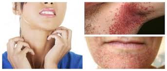 CANDIDIASIS: causas y sintomas