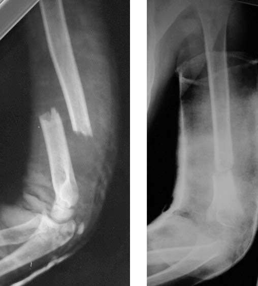 Figura 11. Fractura transversa desplazada de la diáfisis