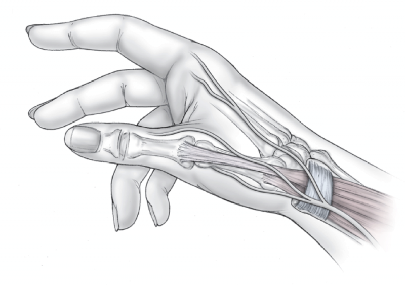 Fisioinforma: Protocolo de fisioterapia para a tenossinovite de De Quervain