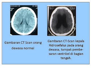Modul Pribadi Koass Radiologi #Hidrosefalus dan Pelebaran ventrikel ...