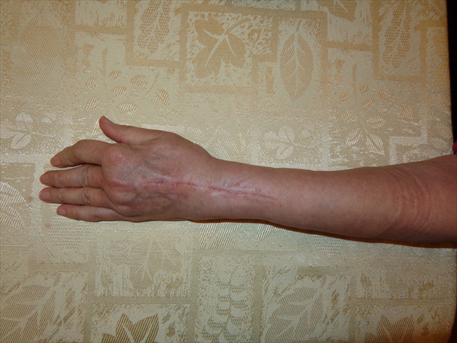 Here's Your Gold Watch - Rheutired: Wrist Fusion Surgery