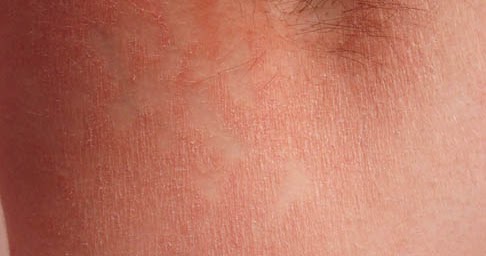 VIRTUAL GRAND ROUNDS IN DERMATOLOGY 2.0: Confluent and Reticulated ...