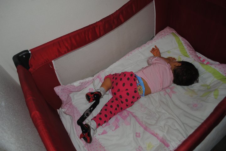 Patologia Pie Bot: Ortesis dinámica Dobbs/click: