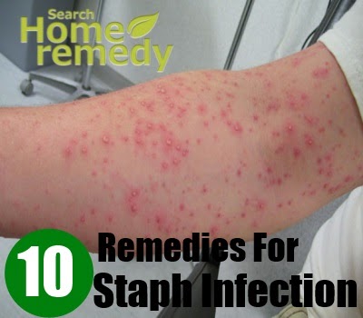 10 HERBAL REMEDIES FOR STAPH INFECTION ~ Mzizi Mkavu