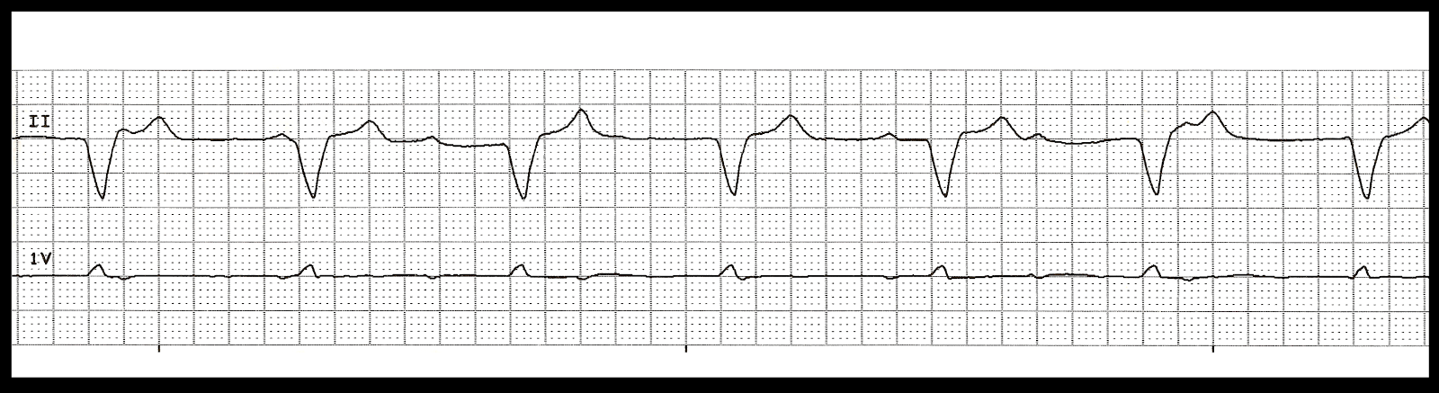 Various Third Degree Heart Blocks