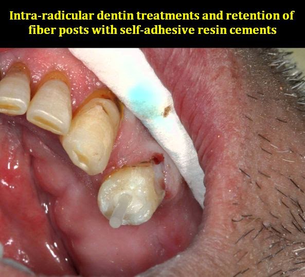 PDF: FIBER POSTS: Intra-radicular dentin treatments and retention of ...