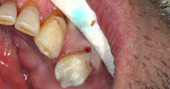 PDF: FIBER POSTS: Intra-radicular dentin treatments and retention of ...