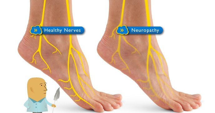 About Health: Peripheral neuropathy