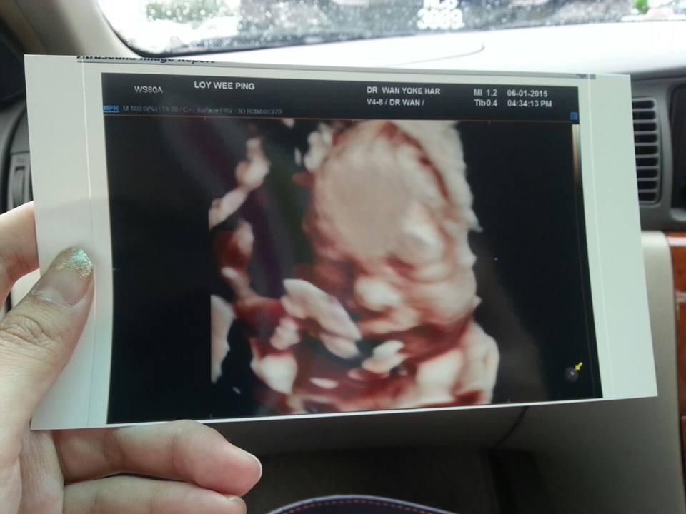 -weEp-'s pregnancy diary!: 5D Ultrasounds