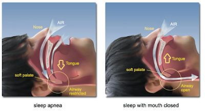 Sleep Apnea Remedies: Do you think Plants can Cure your Sleep Apnea?