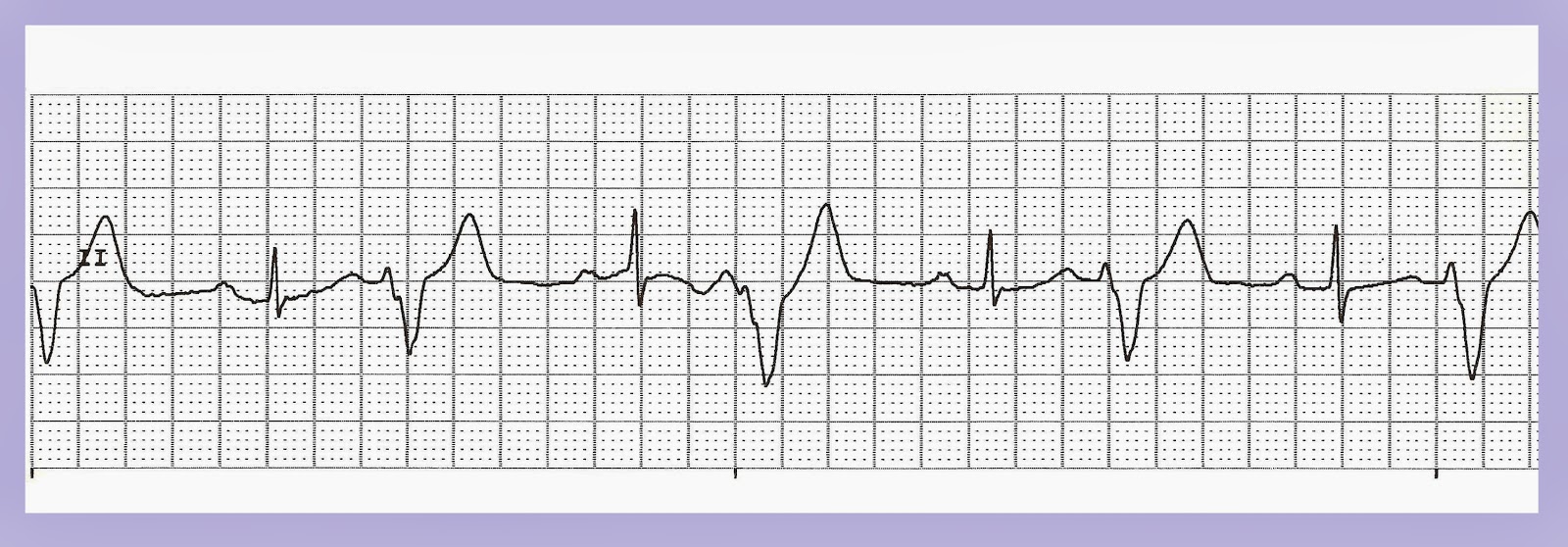 Basic EKG Rhythm Test 22