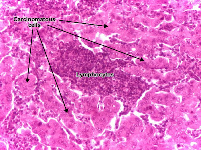 موقع الدكتور أحمد كلحى: صور باثولوجى - ﻿Patholgy Slides : Tumors or ...