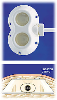 Andrew Aidan's Story: Infected Mediport & It Will Be Removed Soon