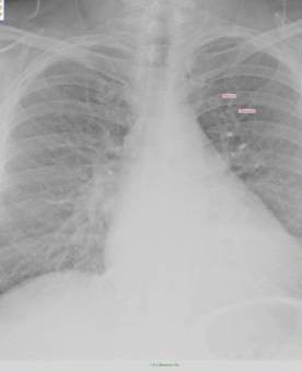Cardiac decompensation-CXR - Sumer's Radiology Blog