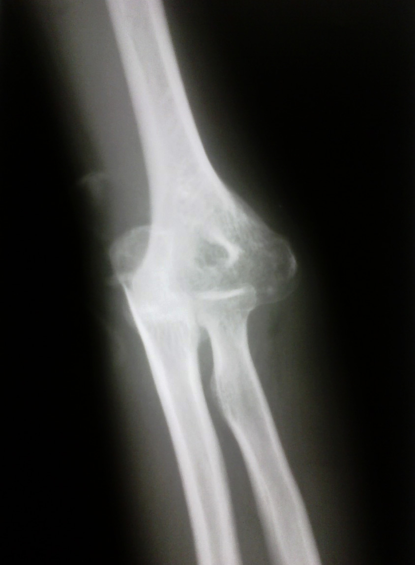 O R T O C R I T I C A: LUXACION INVETERADA DE CODO DERECHO (5 MESES EVOL)