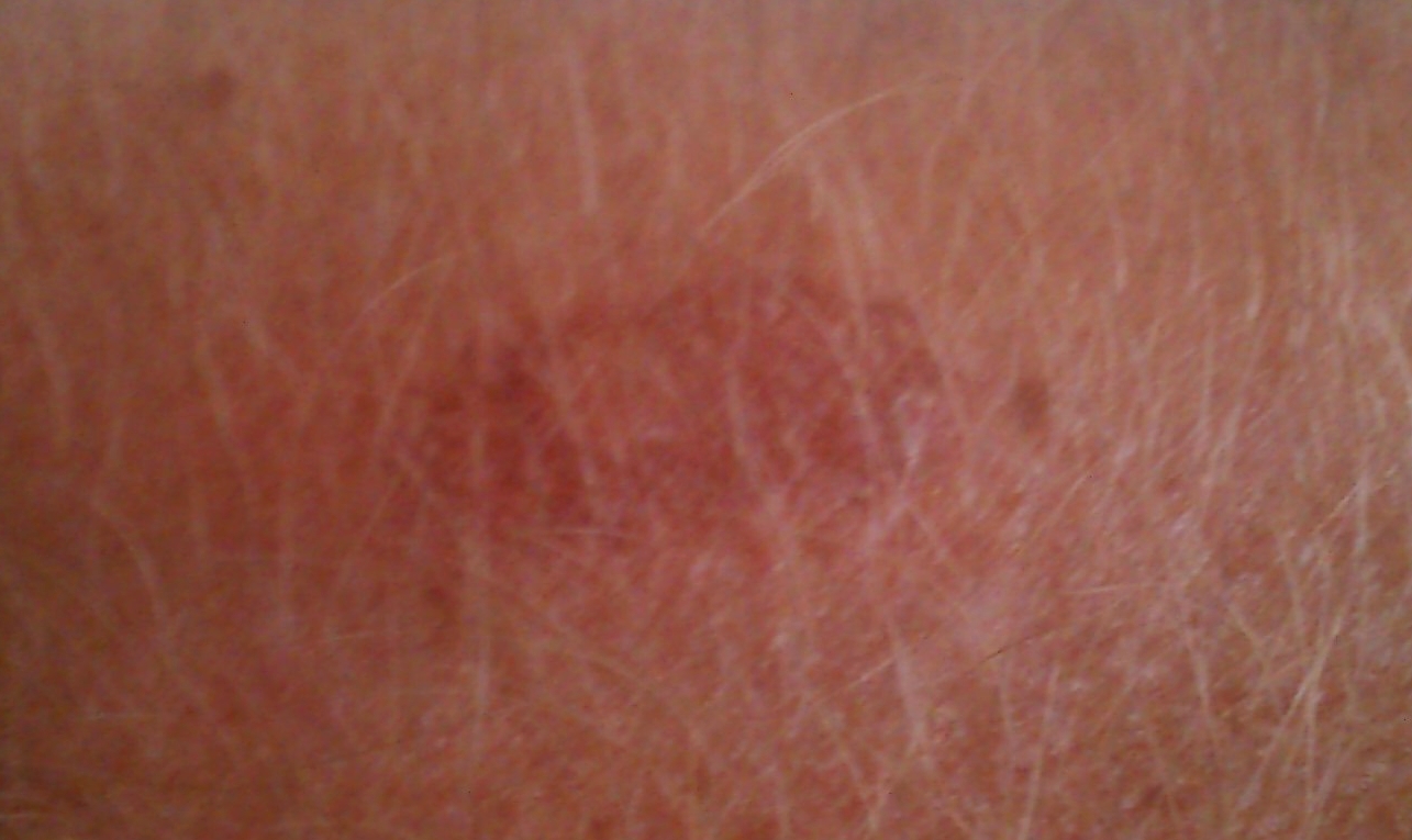 Zaklopen Op Zee: Huidkanker zelf ontdekken via app - AD.nl