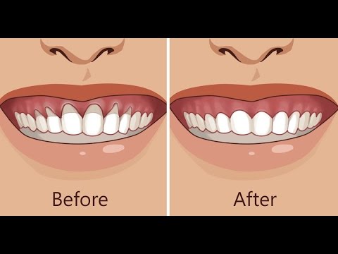 Best Natural Cures To Reverse Receding Gums Without Surgery