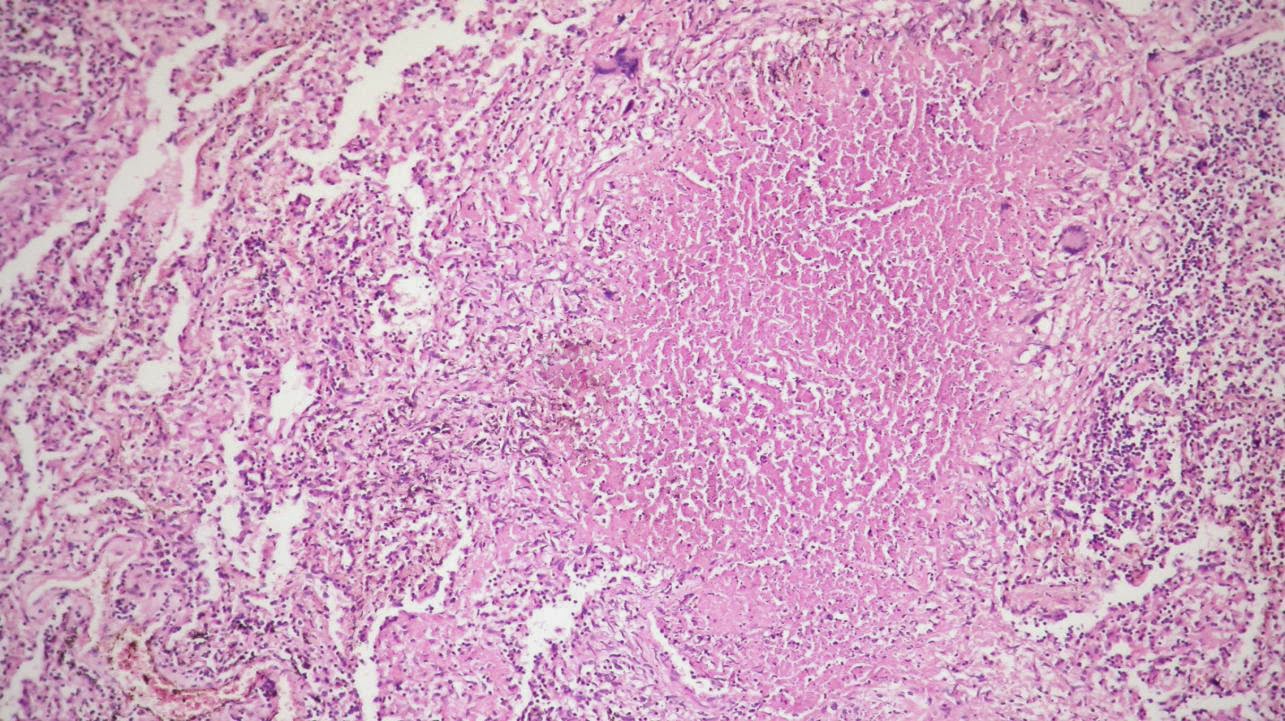 2. Necrosis pulmonis /№ 58 Bronchopneumonia tbc caseosa./ | Pathology