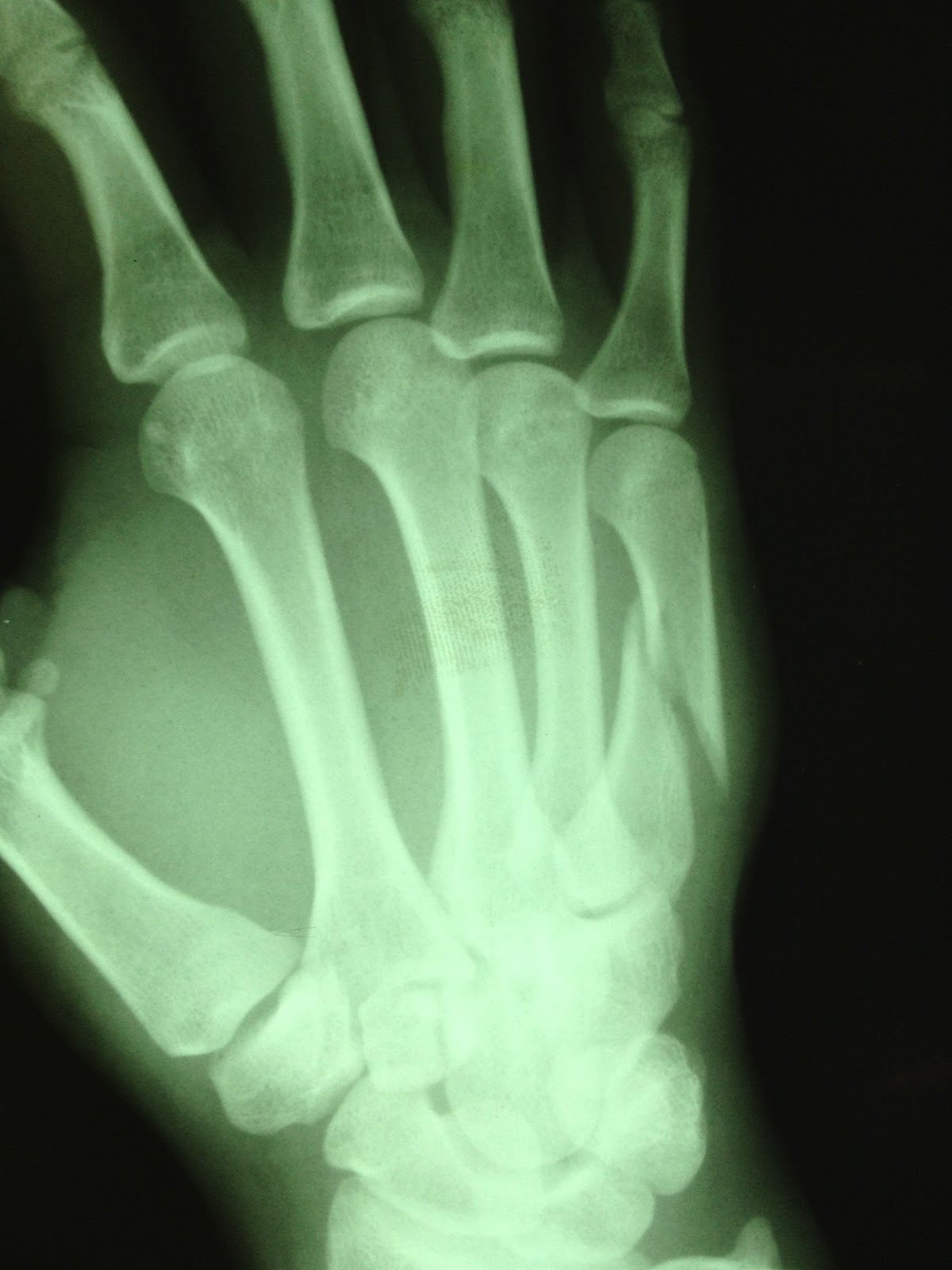 OSSA CARPALIA ©: OSTEOSÍNTESIS PERCUTANEA 5º METACARPIANO