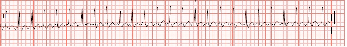 EKG Rhythm Strip Quiz 60