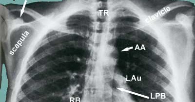 Gambaran Khas Radiologi Penyakit Sistem Respirasi - CatatanDokter