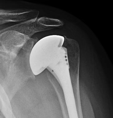 Shoulder Arthritis/Joint Replacement Rotator cuff tears: The B2 glenoid ...