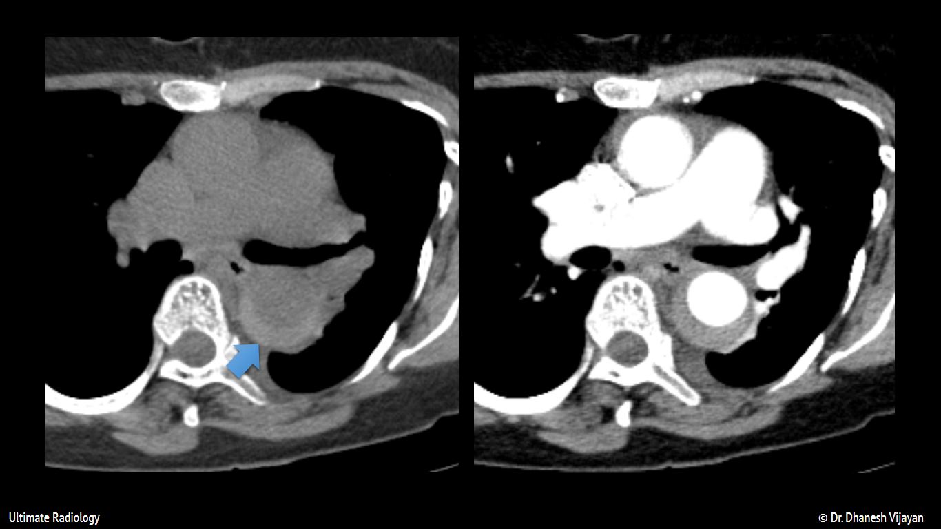 Ultimate Radiology : Aortic Dissection : Stanford Type B