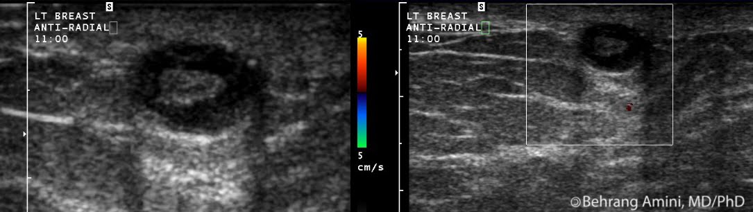 Tunica Albuginea Cyst