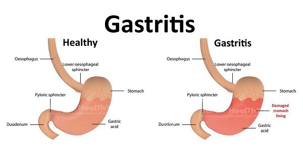 ДКЦ "СВ. ГЕОРГИ" гр. Пловдив: От гастрит основно страдат по ...