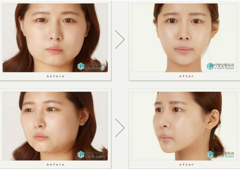 Bệnh Viện Thẩm Mỹ TL Hàn Quốc: [Facial contouring] Quick zygoma ...