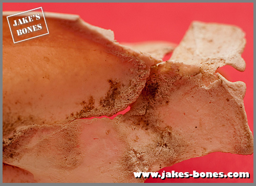 Strange bones #14: Two weird bone pathologies : Jake's Bones