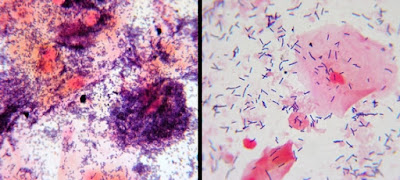 Fun With Microbiology (What's Buggin' You?): Bacterial Vaginosis