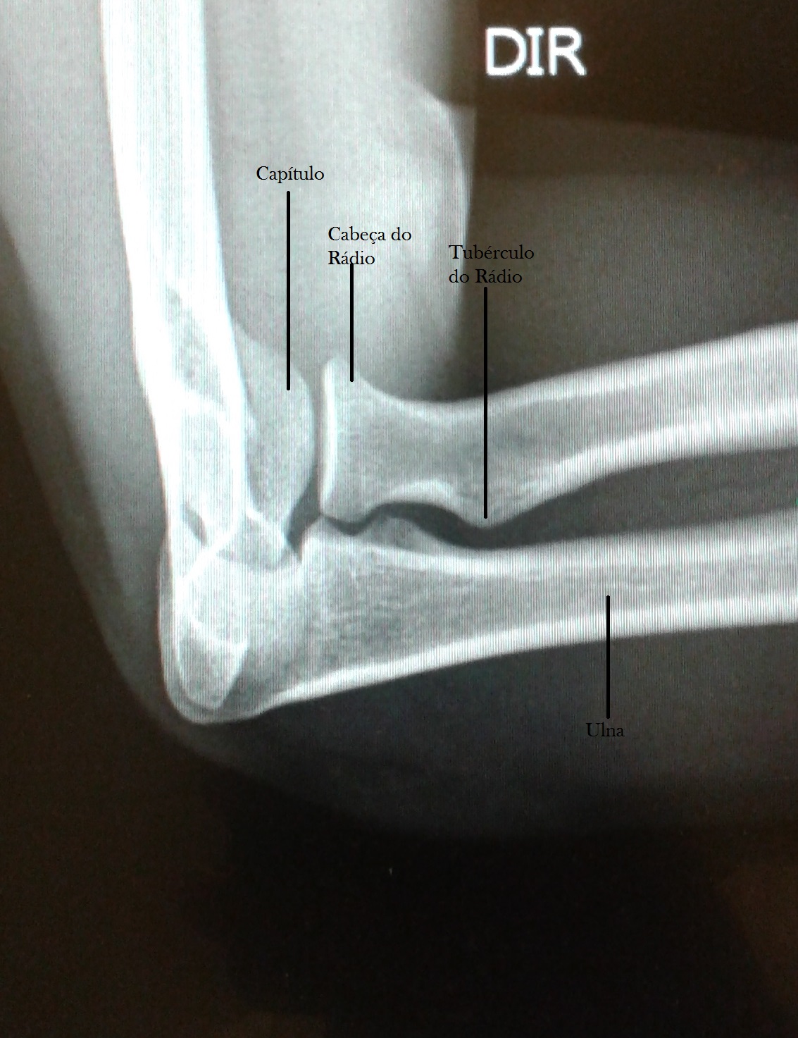 RADIOLOGIA: TÉCNICAS RADIOLÓGICAS - MEMBROS SUPERIORES - COTOVELO ...