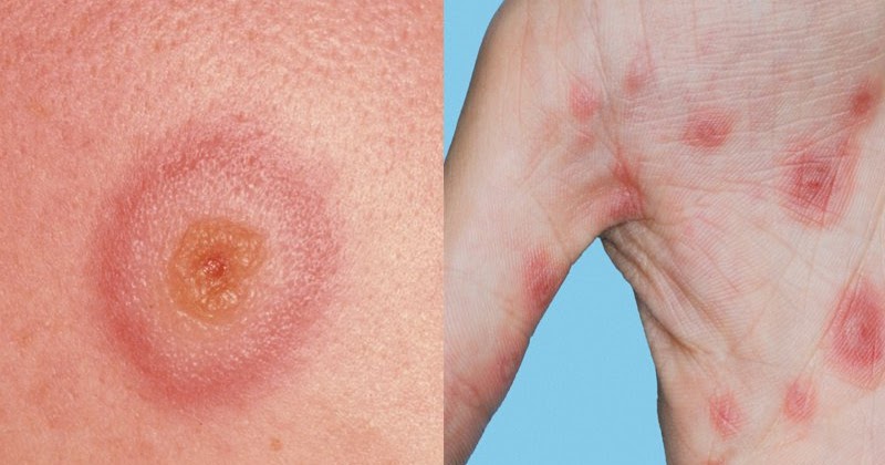 What Is Erythema Multiform? - Teroes