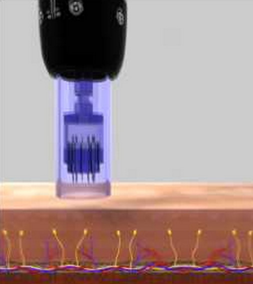 Dermapen Needling With Platelet Rich Plasma | Naples MD